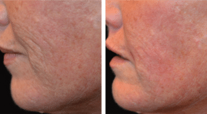 Fillers for laugh lines | Plastic Surgeon San Francisco | Pacific ...