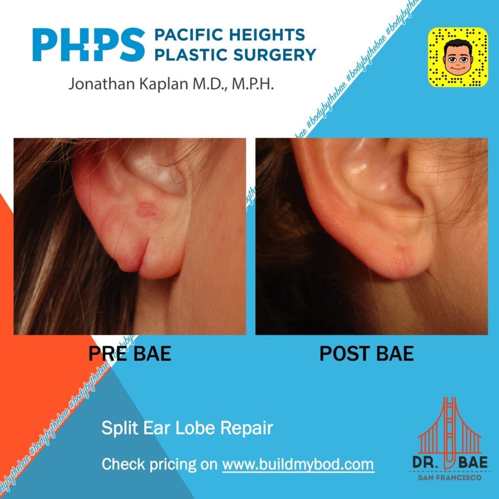 Before-and-After-Split-Ear-Lobe-Repair | Plastic Surgeon San Francisco ...