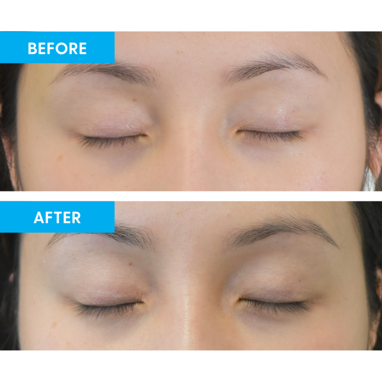 How to avoid duck lips with lip filler | Plastic Surgeon San Francisco ...